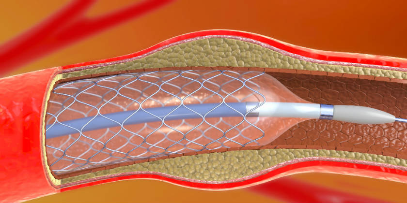 Se afianza el «stent» en RD casos obstrucción de arterias | AlMomento ...